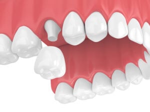 The Purpose Of A Temporary Crown - Dental Implant Center At Walnut Creek